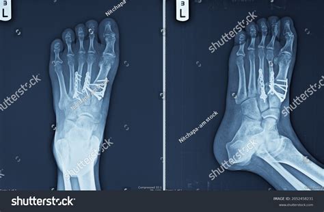 Open Reduction Internal Fixation Over 10 Royalty Free Licensable Stock Illustrations And Drawings