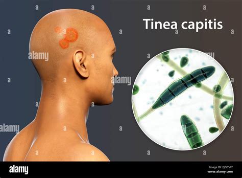 Ringworm Scalp Hi Res Stock Photography And Images Alamy