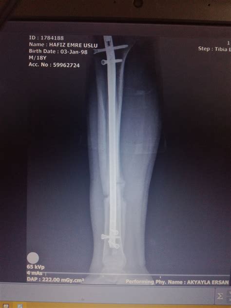 Tibia Fibula Fracture Treatment Tibia Fibula Bone Surgery