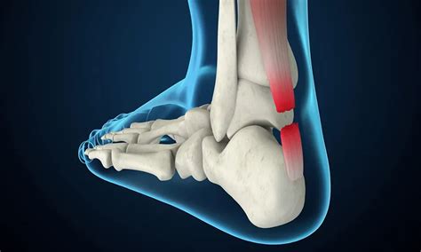 Calcaneus Fractures For Austin And Bee Cave Tx Austin Foot And Ankle
