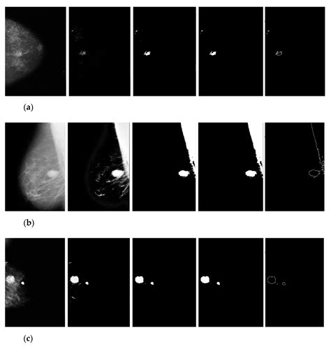 Breast Cancer Detection In Mammogram Images Using Kmeans Clustering