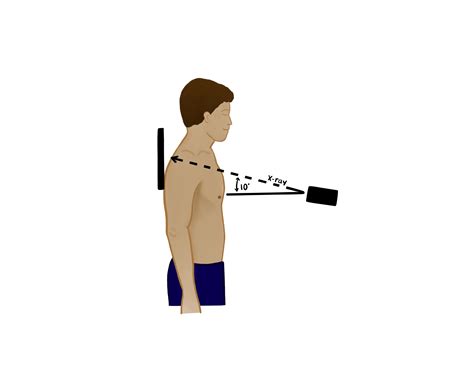 Acromioclavicular Separation