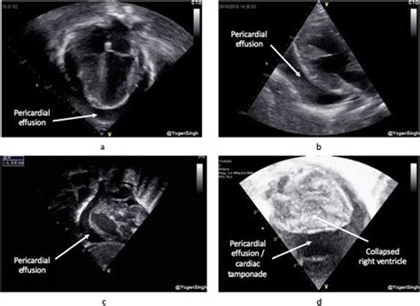 Pericardial Effusion Ultrasound