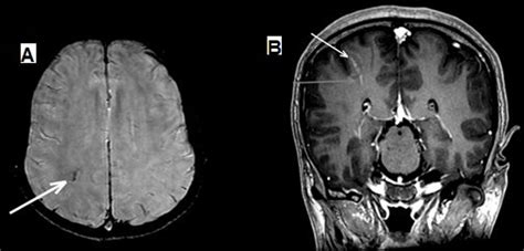 Detection Of Venous Angiomas On Susceptibility Enhanced Magnetic
