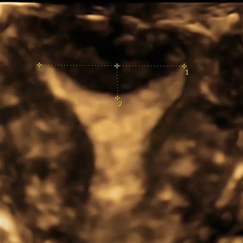 3d Pelvic Scan Sonacare