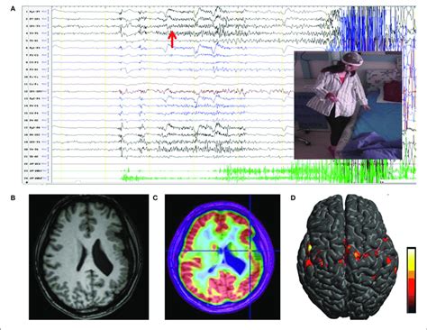A Ictal Eeg Originated In The Left Unilateral Pmg The First Ictal Download Scientific