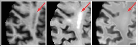 Figure 1 From Brain Lesion Segmentation Through Image Synthesis And Outlier Detection Semantic