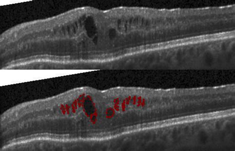 Currently I Am Training A Model That Detects Cme On Optical Coherence