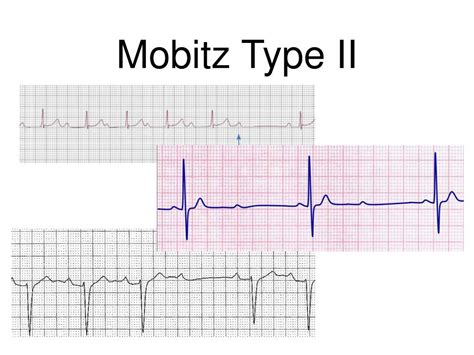 Ppt Atrioventricular Av Heart Block Powerpoint Presentation Free