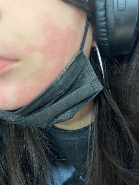 Adbry Flare R Eczemabs