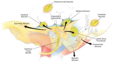 Complications Of Chronic Otitis Media Ento Key