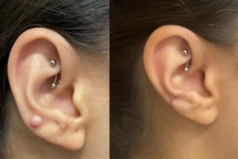 Ear Keloids Why They Form And How We Treat Them Differently London