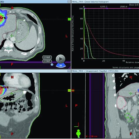 Pdf Efficacy And Safety Of Ultrasound Guided Implantation Of Fiducial Markers In The Liver For