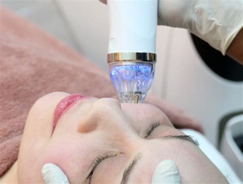 Does Rf Microneedling Really Deliver Better Results Than Traditional