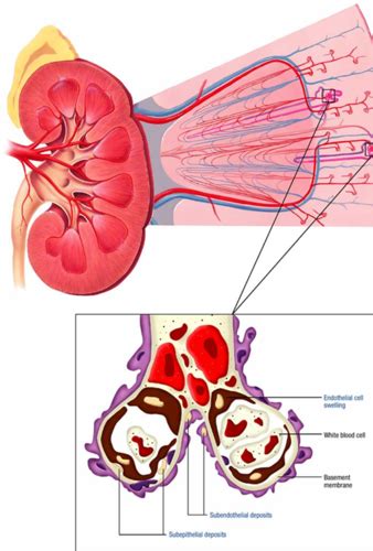 Glomerular Disorders Flashcards Quizlet