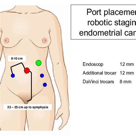 Schematic Demonstration Of The Port Placement In Robotic Assisted Download Scientific Diagram