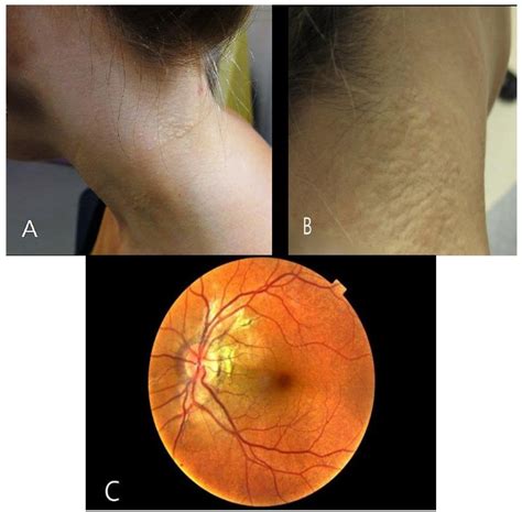 Figure 1 From Case Report Pseudoxanthoma Elasticum Case Report Semantic Scholar