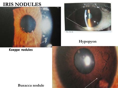 Uvea And Sclera