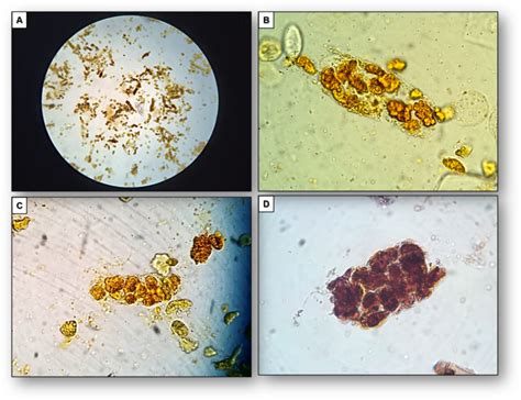 Urine Sediment Of The Month Findings In Cirrhosis Cholestasis And Hyperbilirubinuria Renal