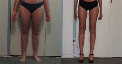 Fat Thighs Before And After