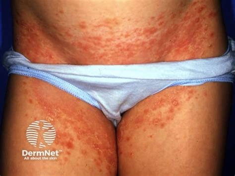 Unilateral Laterothoracic Exanthem