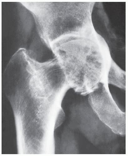 Degenerative Joint Disease Radiology Key