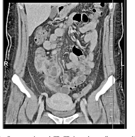 Figure 1 From A Case Of Diffuse Neuronal Hypertrophy In Acute Appendicitis Semantic Scholar