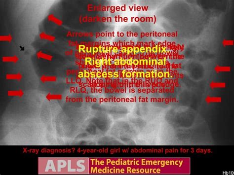 Apls Pediatric Emergency Radiology PPT