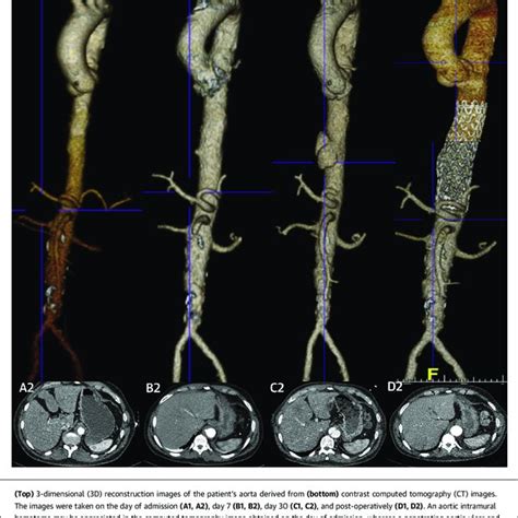 Ct Scan Showing An Intimal Flap And Stanford Type B Aortic Dissection