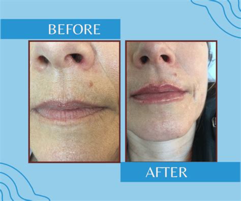 The Transformation With Lip Fillers Before And After 1ml