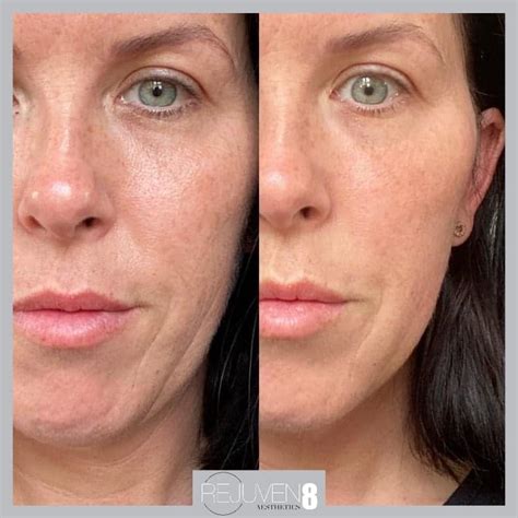 Profhilo The Bio Remodelling Rejuven8 Aesthetics