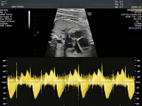 Fetal Ultrasound Power Doppler Measuring The Pr Interval As Part Of A