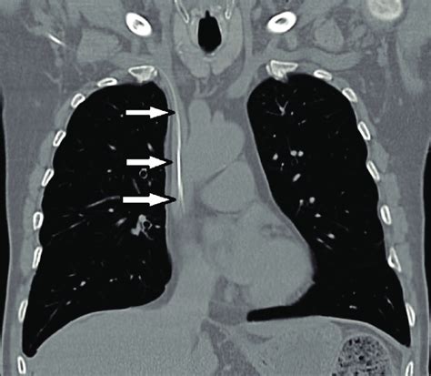 A Chest Ct Scan Shows The Correct Positioning Of The Picc Arrows Download Scientific Diagram