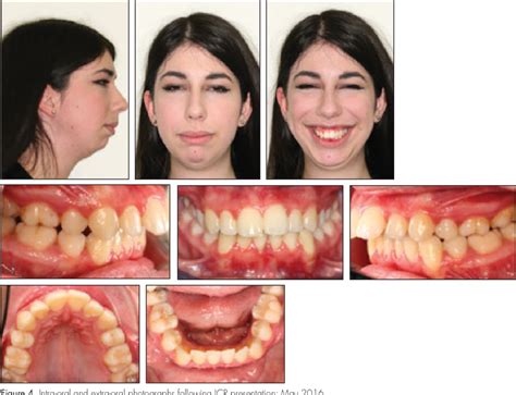Figure 4 From A Case Of Idiopathic Condylar Resorption Semantic Scholar