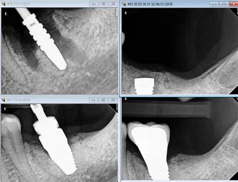 Crestal Bone Loss From Implant Surgery Cause Bauer Smiles
