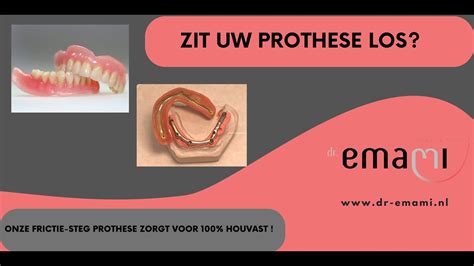 Kunstgebit Implantaat Frictie Steg Gehemelte Vrije Prothese Youtube