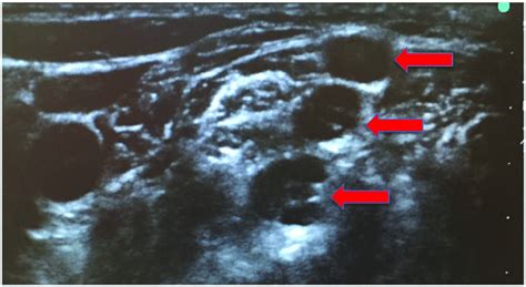 Ultrasonographic Image Of The Brachial Plexus In The Interscalene Download Scientific Diagram