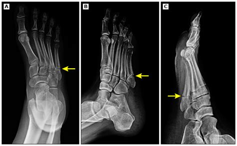Avulsion Fracture 5th Metatarsal