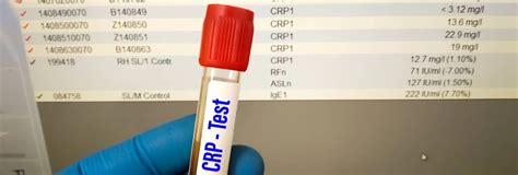 CRP Test Normal Range Purpose Results Explained