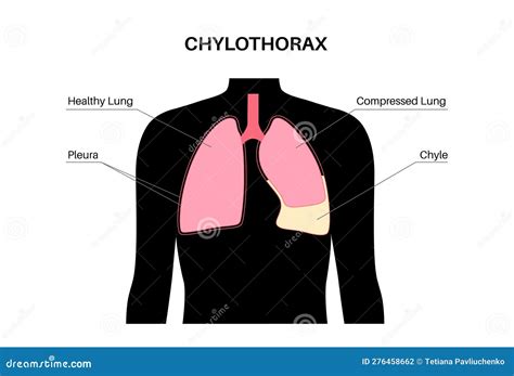 Chylothorax Anatomical Poster Vector Illustration