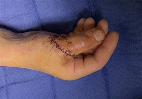 Primary Extensor Tendon Repair Hand And Nerve Surgeon