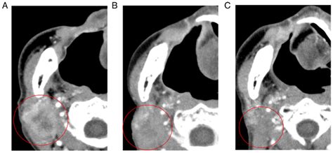 Regional Recurrent Oral Squamous Cell Carcinoma In Case 1 Red Circle
