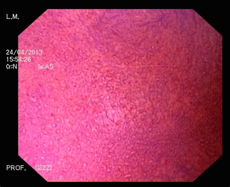 6 Lst Ng Pseudodepressed Center Colon Explorer 6 Lst Ng Pseudodepressed Center Colon Explorer