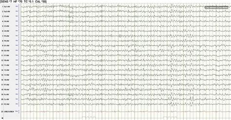 Learn To Read EEG With Practice Questions NowYouKnow Neuro Learn To Read Subdural