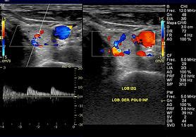 ULTRASONIDOS DOPPLER | idylac