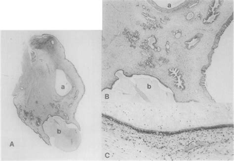 Maxillary Sinus Polyp Semantic Scholar