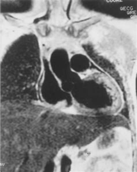 Abundant Myxoid Matrix Containing A Variable Number Of Fibroblast Like