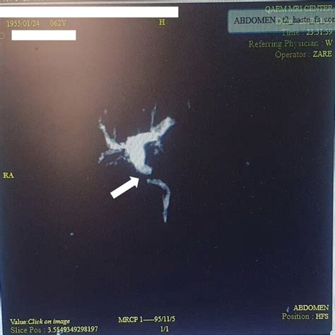 Preoperative Mrcp Stenosis Evidence Arrow Download Scientific Diagram