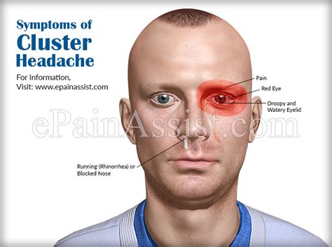 Cluster Headache Symptoms Causes Treatment Diagnosis