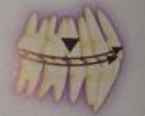 Occlusal plane with a profound Spee curve Figure extracted from Simões Download Scientific